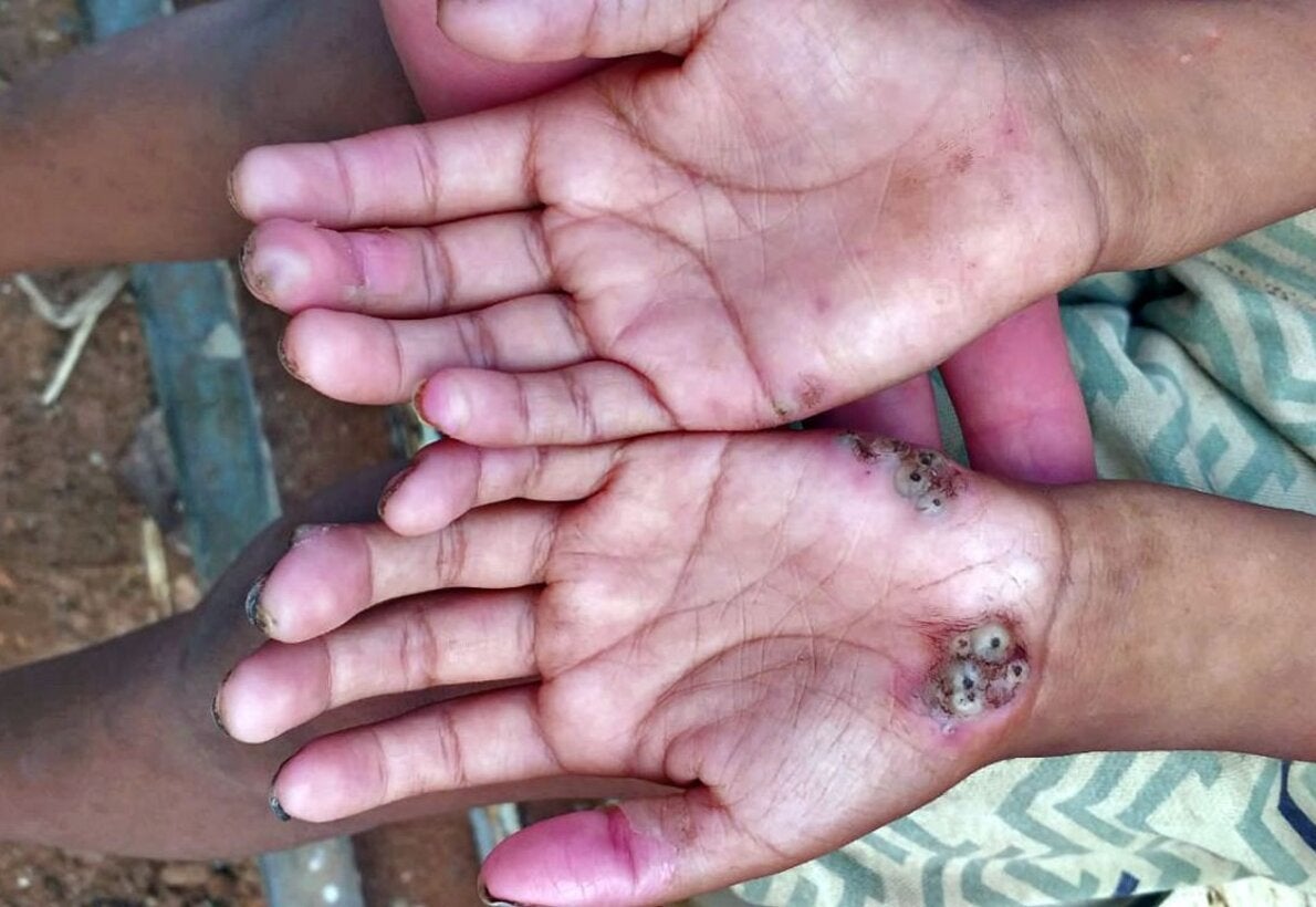 Anniversary Photo Exhibit: Communicable Diseases - PAHO/WHO | Pan ...